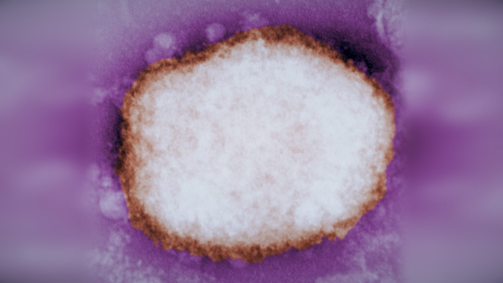 Second case of monkeypox discovered in Alberta - CityNews Calgary
